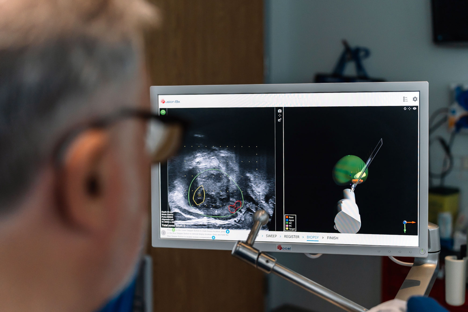 TRUS vs MRI Fusion Prostate Biopsy - Urology Innovations Canada